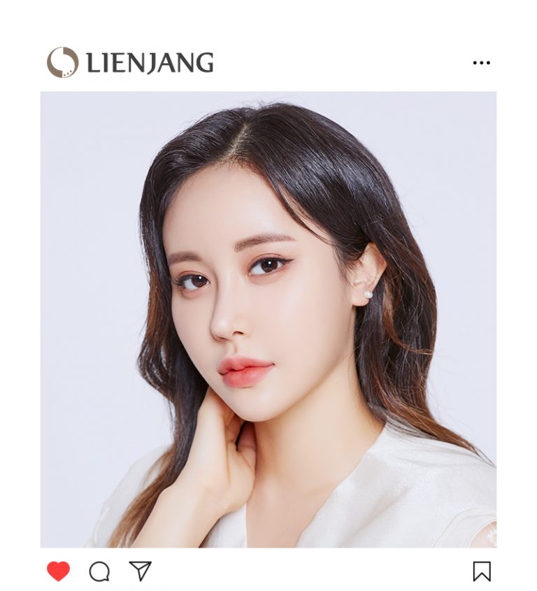 Revision Rhinoplasty - Lienjang Clinic Korea