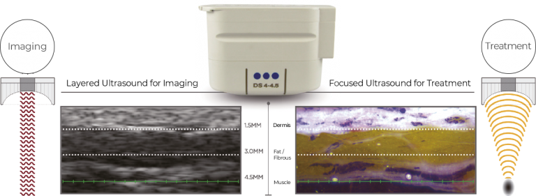 Ultherapy - Lienjang Clinic Korea