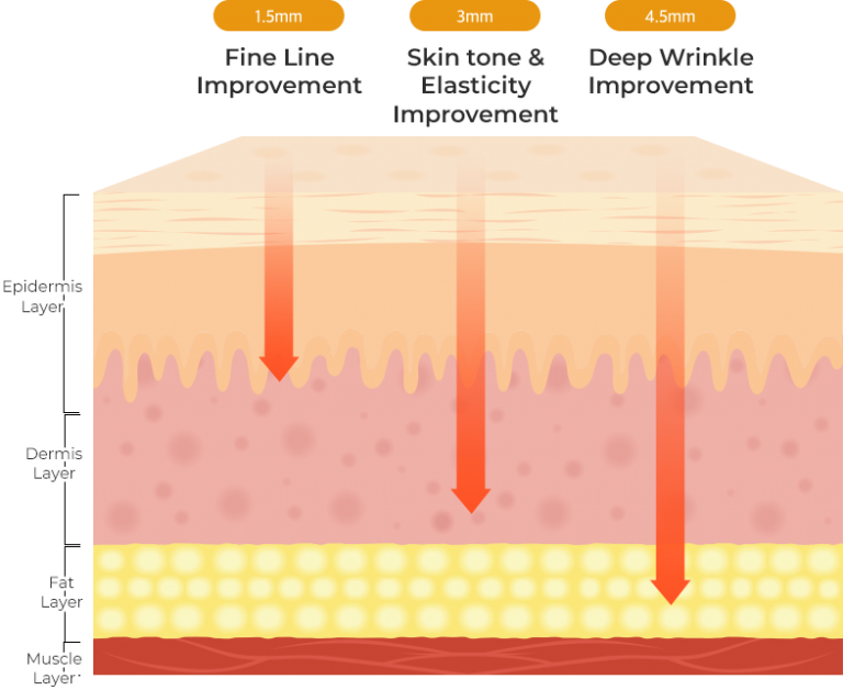 Ultherapy - Lienjang Clinic Korea