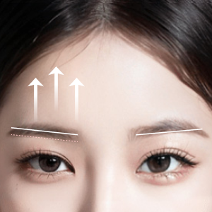 Endotine® Lift - Lienjang Clinic Korea