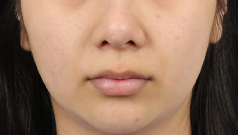 Ultrasound-Guided Thread Lifting - Lienjang Clinic Korea