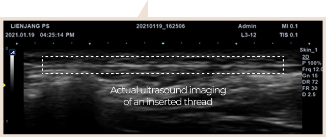Ultrasound-Guided Thread Lifting - Lienjang Clinic Korea